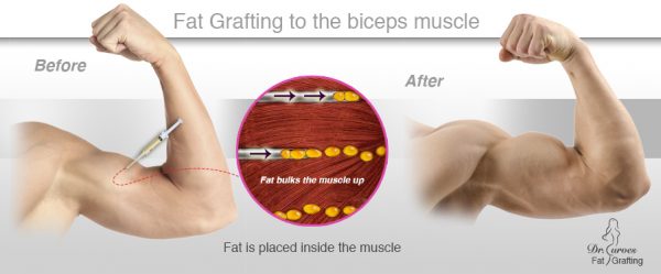 Fat Grafting - Dr Curves