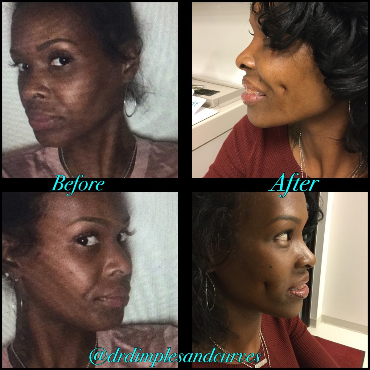 What A Huge Difference A Little Dimple Can Do To Your Smile... - Dr Curves